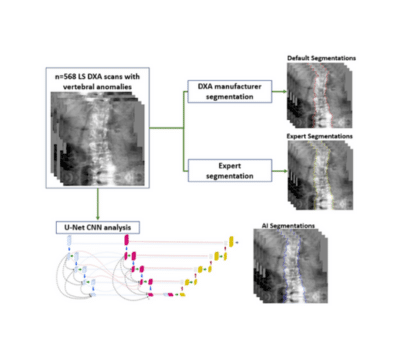 Improving DXA lumbar spine BMD outcomes with a new AI-based spine ...