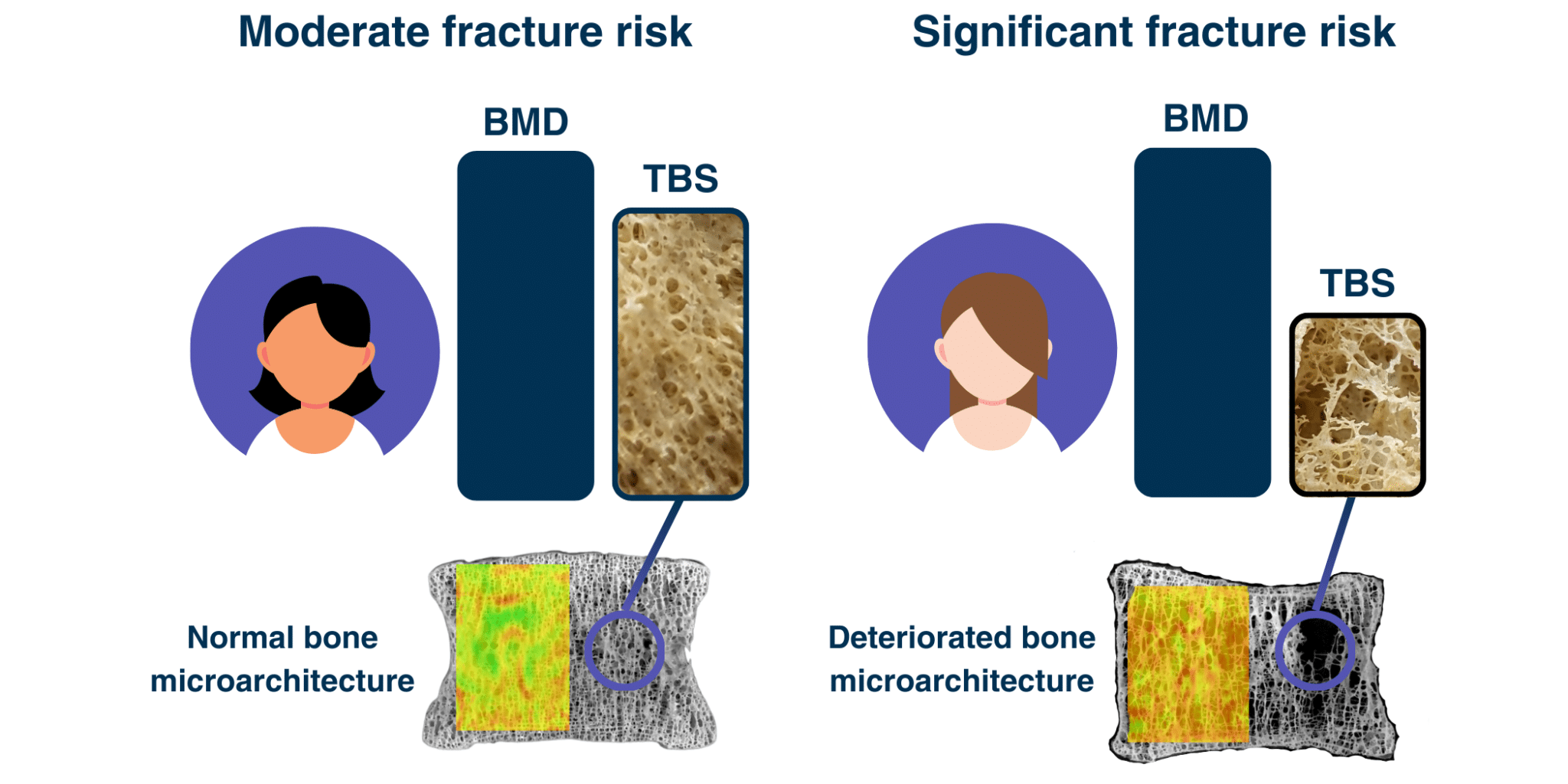 TBS Osteo: osteoporosis fracture risk assessment software - Medimaps