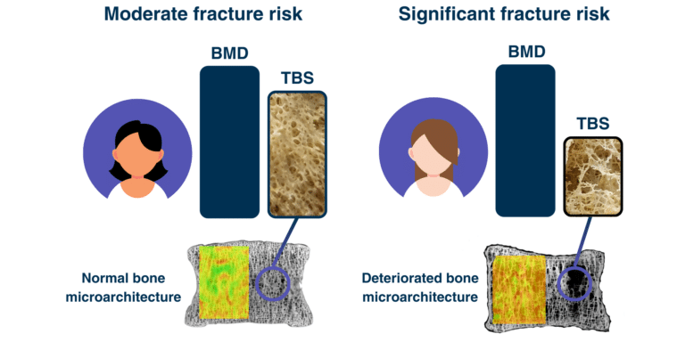 TBS Osteo: osteoporosis fracture risk assessment software - Medimaps