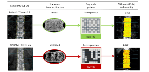 Trabecular Bone Score (TBS) - Medimaps