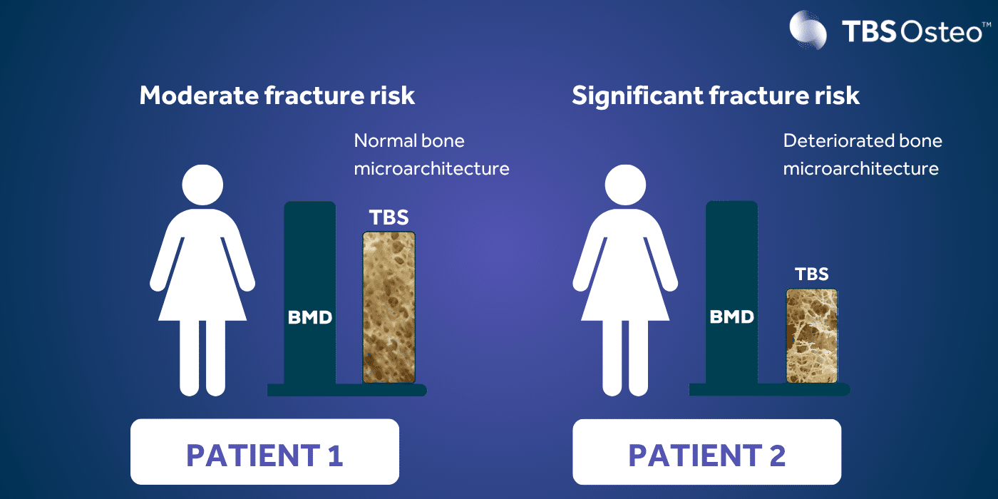 How the next generation of TBS Osteo: TBS Osteo Advanced is ...
